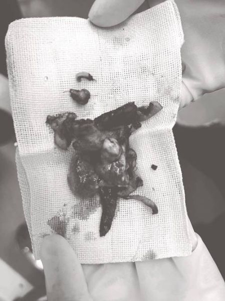 拉皮是怎么做出来的_拉皮手术全过程揭秘-第3张图片-山城妙识 拉皮是怎么做出来的_拉皮手术全过程揭秘-第3张图片-山城妙识