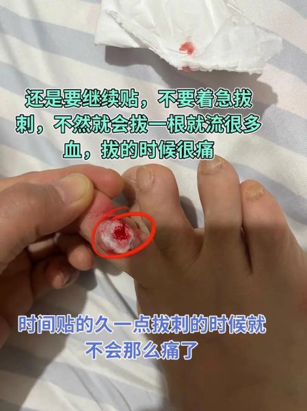 鸡眼怎么治_鸡眼贴多久能好-第3张图片-山城妙识 鸡眼怎么治_鸡眼贴多久能好-第3张图片-山城妙识