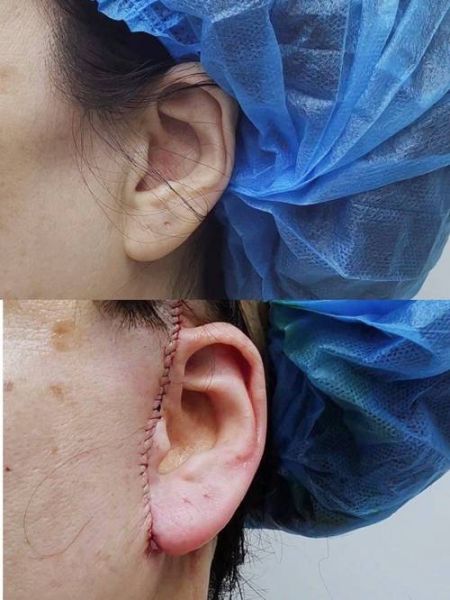 拉皮是怎么做出来的_拉皮手术全过程揭秘-第2张图片-山城妙识 拉皮是怎么做出来的_拉皮手术全过程揭秘-第2张图片-山城妙识