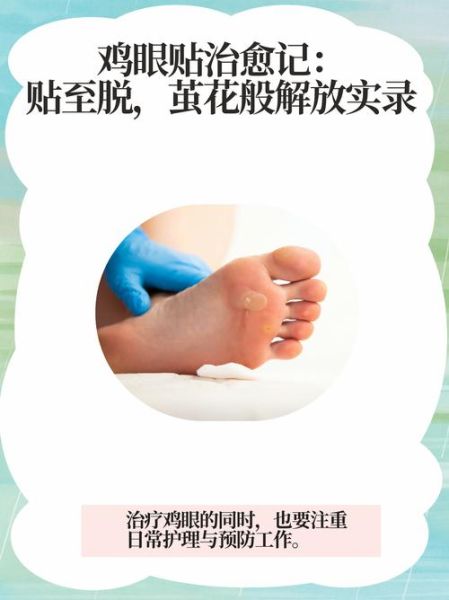 鸡眼怎么治_鸡眼贴多久能好-第1张图片-山城妙识 鸡眼怎么治_鸡眼贴多久能好-第1张图片-山城妙识