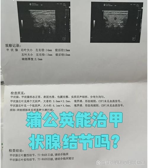 蒲公英能治甲状腺结节吗_效果与风险解析-第3张图片-山城妙识 蒲公英能治甲状腺结节吗_效果与风险解析-第3张图片-山城妙识