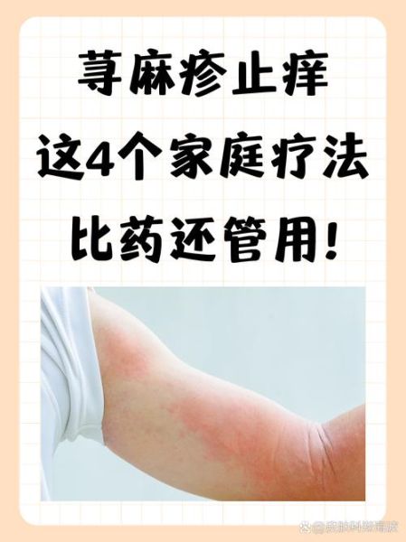 荨麻疹最快治疗方法_荨麻疹怎么止痒-第1张图片-山城妙识 荨麻疹最快治疗方法_荨麻疹怎么止痒-第1张图片-山城妙识