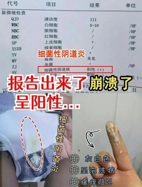 豆腐渣白带一周后自愈_豆腐渣白带能自己好吗-第1张图片-山城妙识