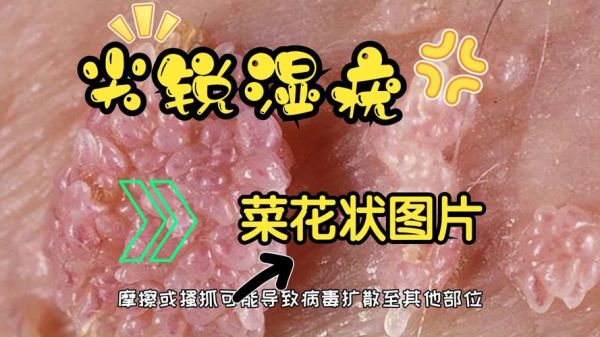男性菜花状疣高清图片_早期症状有哪些-第3张图片-山城妙识 男性菜花状疣高清图片_早期症状有哪些-第3张图片-山城妙识