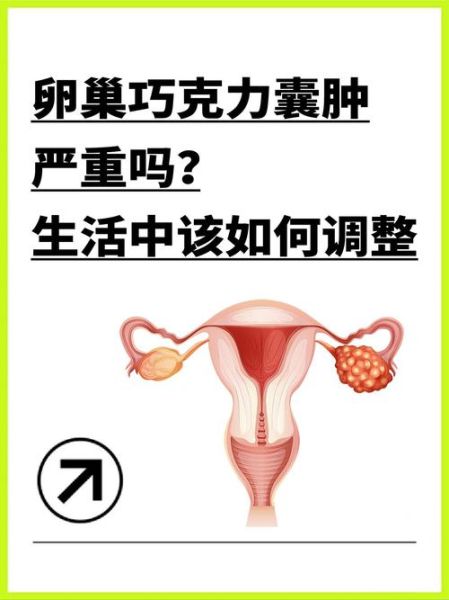 巧克力囊肿症状有哪些_巧克力囊肿会癌变吗-第3张图片-山城妙识