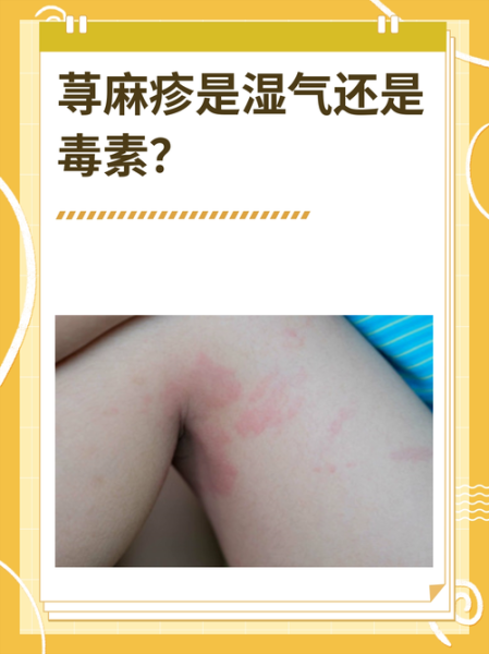 荨麻疹是毒素还是湿气_中医西医怎么看-第2张图片-山城妙识