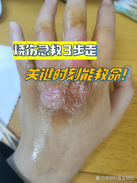辣椒素严重渗透到皮肤里怎么办_辣椒素灼伤皮肤急救-第3张图片-山城妙识