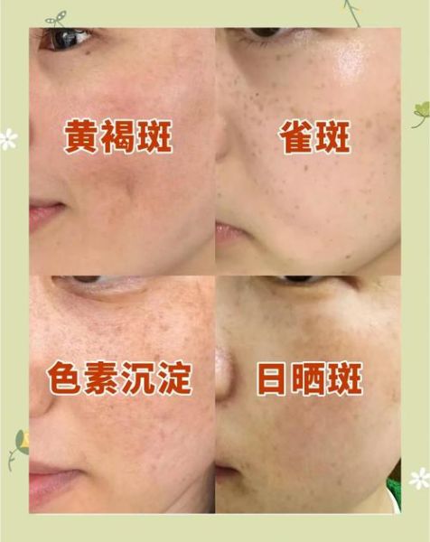 黄褐斑怎么淡化_黄褐斑图片怎么看-第1张图片-山城妙识 黄褐斑怎么淡化_黄褐斑图片怎么看-第1张图片-山城妙识