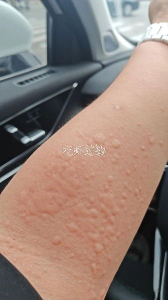 吃虾的禁忌人群有哪些_虾过敏能吃吗-第3张图片-山城妙识