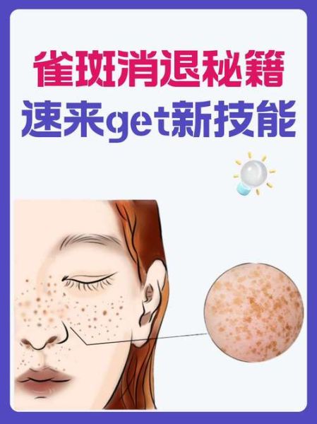 雀斑怎么去除_雀斑去除最有效的方法-第2张图片-山城妙识