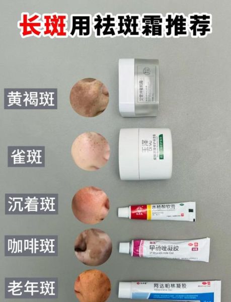 雀斑怎么去除_雀斑去除最有效的方法-第3张图片-山城妙识