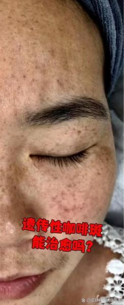 牛奶咖啡斑是什么_牛奶咖啡斑会遗传吗-第1张图片-山城妙识 牛奶咖啡斑是什么_牛奶咖啡斑会遗传吗-第1张图片-山城妙识