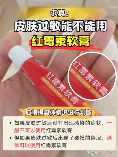 红霉素软膏禁忌人群_红霉素软膏不能和什么一起用-第1张图片-山城妙识