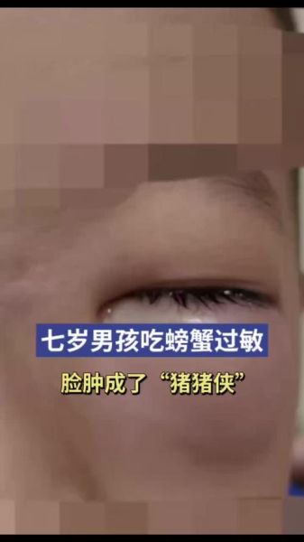 螃蟹过敏几个小时后自愈_多久算正常-第1张图片-山城妙识 螃蟹过敏几个小时后自愈_多久算正常-第1张图片-山城妙识