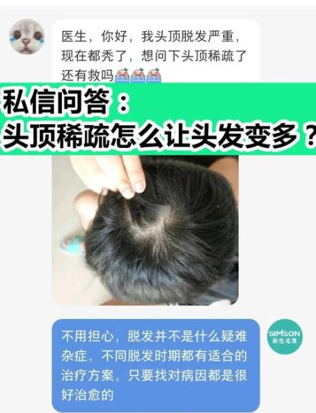 头发稀少怎么变浓密_如何让头发变多-第1张图片-山城妙识