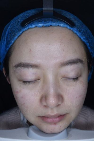 蜂巢皮秒祛斑效果怎么样_蜂巢皮秒恢复期多久-第1张图片-山城妙识