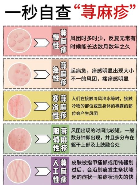 荨麻疹最怕三个土方法_真的有用吗-第1张图片-山城妙识 荨麻疹最怕三个土方法_真的有用吗-第1张图片-山城妙识