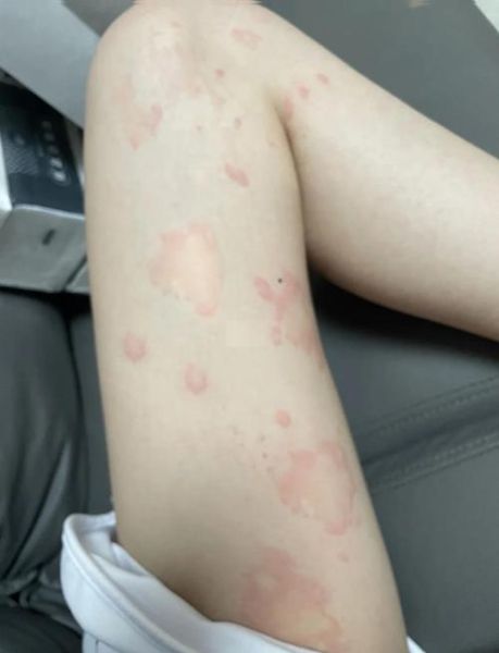 荨麻疹最怕三个土方法_真的有用吗-第3张图片-山城妙识 荨麻疹最怕三个土方法_真的有用吗-第3张图片-山城妙识