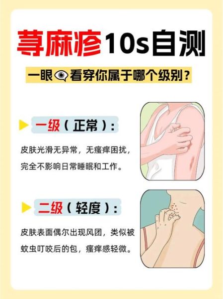 荨麻疹最怕三个土方法_真的有用吗-第2张图片-山城妙识 荨麻疹最怕三个土方法_真的有用吗-第2张图片-山城妙识