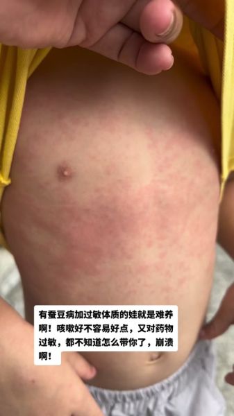 蚕豆病发作有哪些症状_蚕豆病急性溶血表现-第1张图片-山城妙识 蚕豆病发作有哪些症状_蚕豆病急性溶血表现-第1张图片-山城妙识