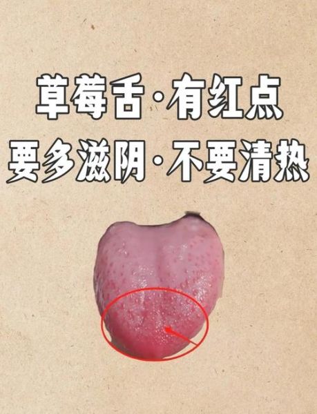 草莓舌头是什么病_草莓舌头怎么治疗-第1张图片-山城妙识