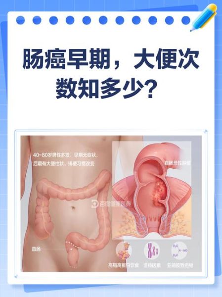 肠癌早期一天几次大便_肠癌早期排便次数变化-第1张图片-山城妙识 肠癌早期一天几次大便_肠癌早期排便次数变化-第1张图片-山城妙识