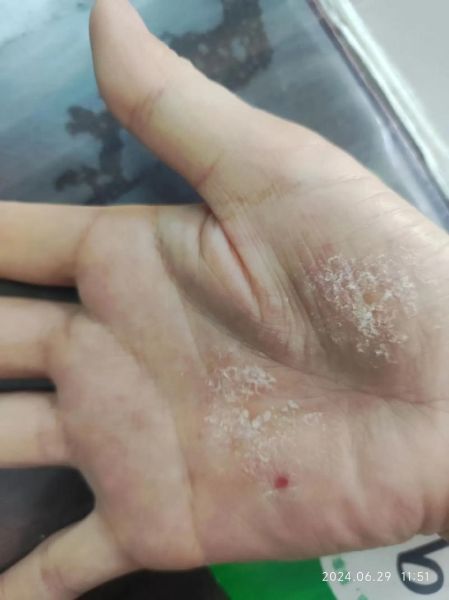 鹅掌风的症状有哪些_鹅掌风初期图片-第1张图片-山城妙识