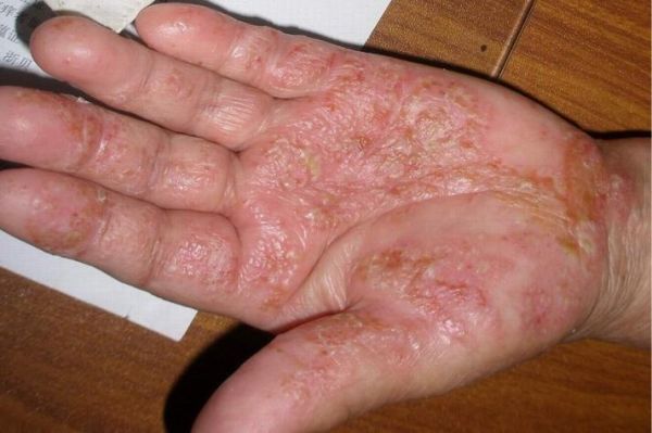 鹅掌风的症状有哪些_鹅掌风初期图片-第2张图片-山城妙识