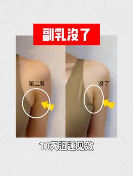 副乳怎么可以消除_副乳消除最有效的方法-第1张图片-山城妙识 副乳怎么可以消除_副乳消除最有效的方法-第1张图片-山城妙识
