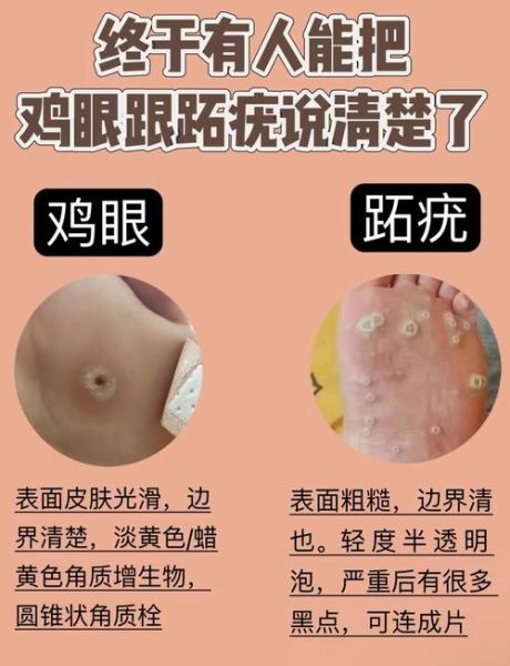 鸡眼图片长什么样_鸡眼和跖疣区别图解-第1张图片-山城妙识 鸡眼图片长什么样_鸡眼和跖疣区别图解-第1张图片-山城妙识