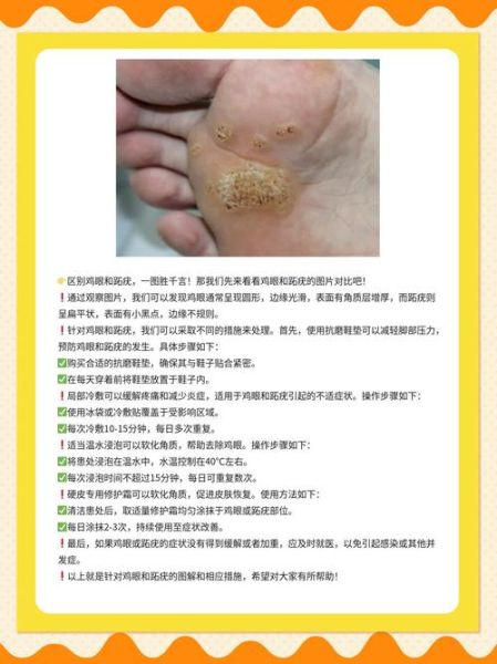 鸡眼图片长什么样_鸡眼和跖疣区别图解-第2张图片-山城妙识 鸡眼图片长什么样_鸡眼和跖疣区别图解-第2张图片-山城妙识