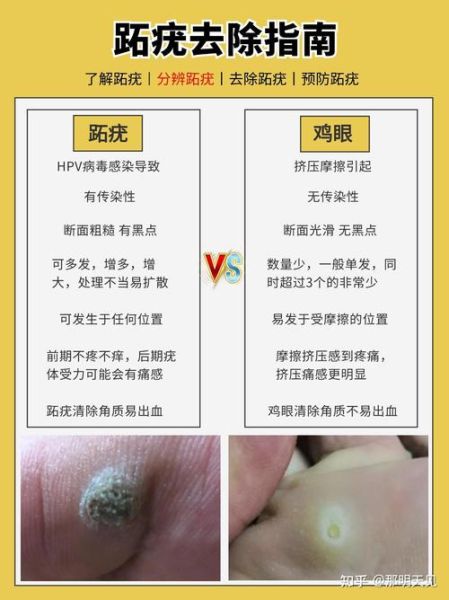 鸡眼图片长什么样_鸡眼和跖疣区别图解-第3张图片-山城妙识 鸡眼图片长什么样_鸡眼和跖疣区别图解-第3张图片-山城妙识