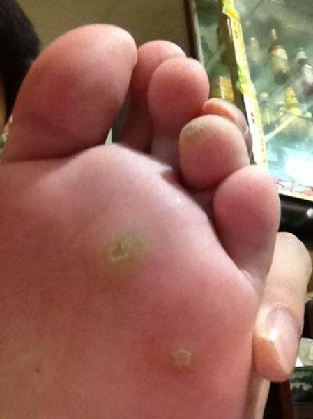 鸡眼图片初期_鸡眼初期症状图片-第3张图片-山城妙识