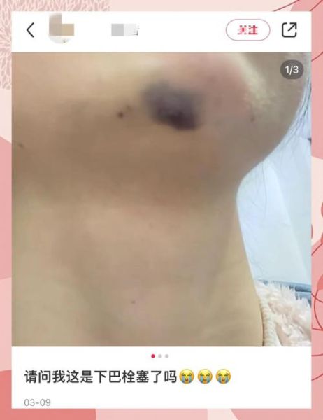 玻尿酸禁忌症有哪些_注射前必须知道的风险-第1张图片-山城妙识