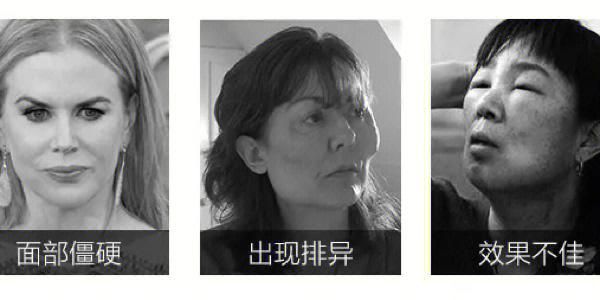 玻尿酸禁忌症有哪些_注射前必须知道的风险-第3张图片-山城妙识