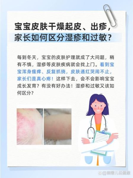 过敏性皮炎湿疹图片_如何辨别症状与类型-第1张图片-山城妙识