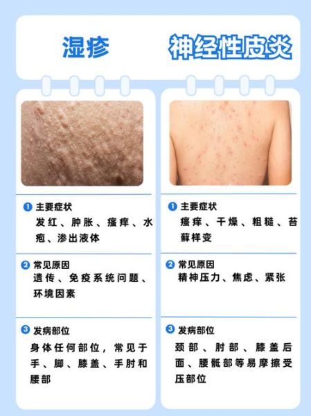 过敏性皮炎湿疹图片_如何辨别症状与类型-第2张图片-山城妙识