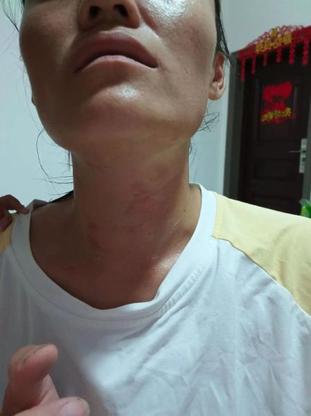 甲亢不到20天就好了_真的可能吗-第1张图片-山城妙识 甲亢不到20天就好了_真的可能吗-第1张图片-山城妙识