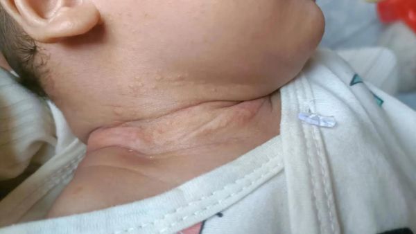 蚕豆病发作症状图片_蚕豆病图片怎么看-第1张图片-山城妙识