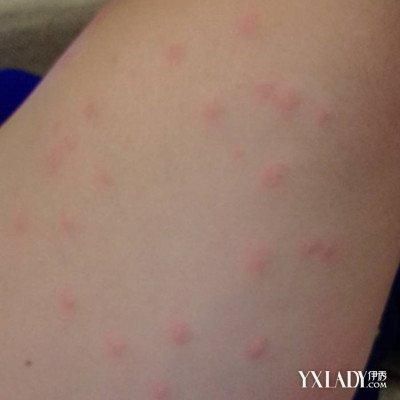 海鲜过敏症状有哪些_如何避免误食海鲜-第3张图片-山城妙识