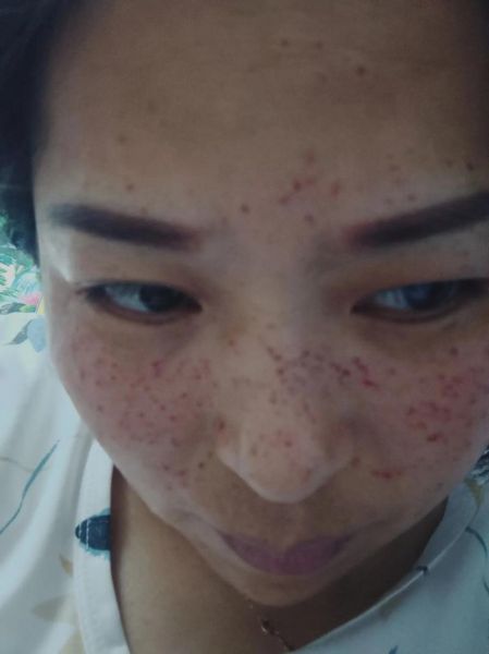 麻子和雀斑的区别_麻子雀斑怎么区分-第3张图片-山城妙识