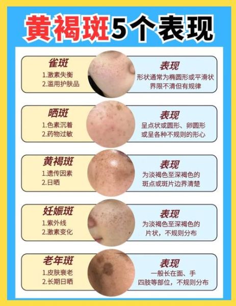 麻子和雀斑的区别_麻子雀斑怎么区分-第2张图片-山城妙识