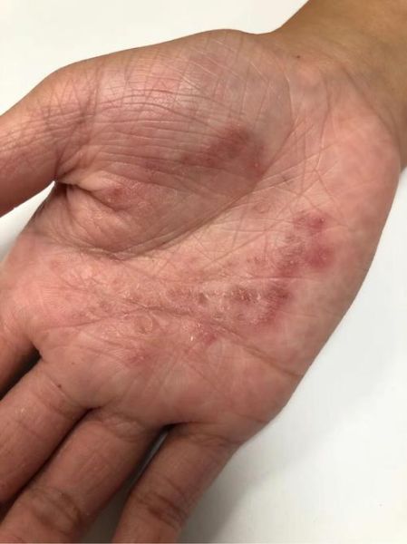 鹅掌风症状图片_鹅掌风初期长什么样-第1张图片-山城妙识 鹅掌风症状图片_鹅掌风初期长什么样-第1张图片-山城妙识