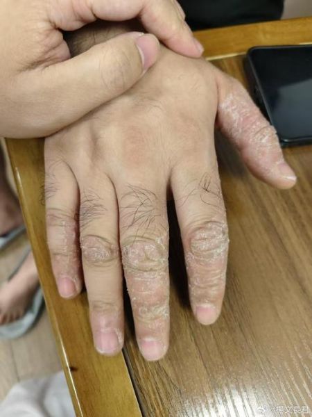 鹅掌风症状图片_鹅掌风初期长什么样-第2张图片-山城妙识 鹅掌风症状图片_鹅掌风初期长什么样-第2张图片-山城妙识