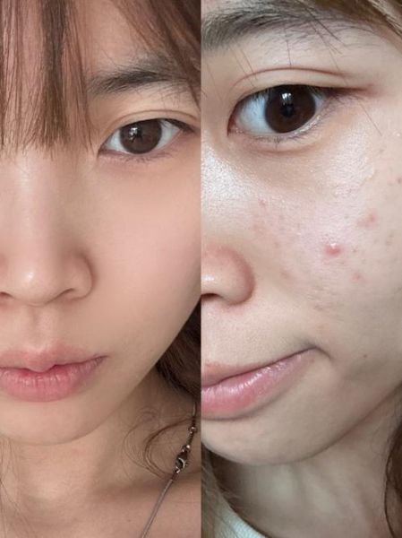 苦瓜汁敷脸可以祛痘吗_苦瓜汁祛痘效果怎么样-第3张图片-山城妙识