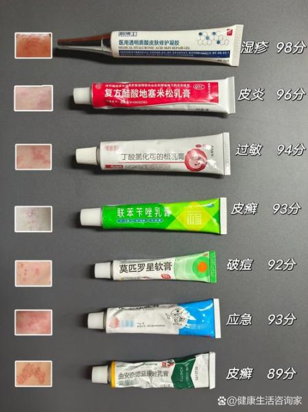 湿疹吃什么药最有效果_湿疹反复发作用什么药好-第2张图片-山城妙识