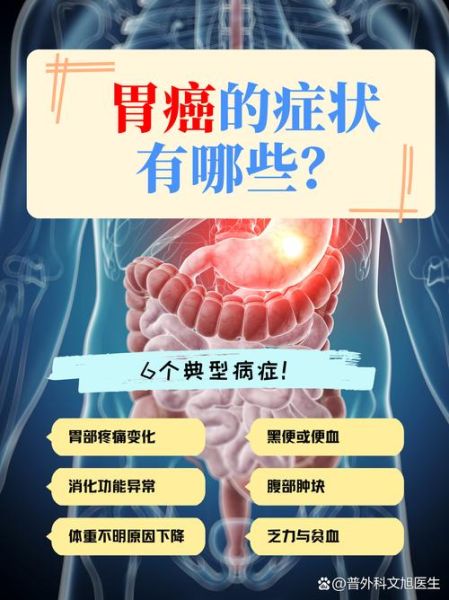 饭后两个症状胃癌来了_是真是假-第2张图片-山城妙识