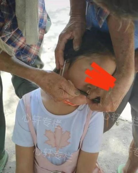 鳝鱼血治面瘫涂哪一侧_面瘫贴鳝鱼血正确位置-第2张图片-山城妙识