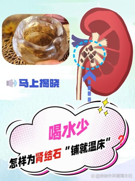 肾结石最怕三种饮水_如何正确喝水排石-第1张图片-山城妙识