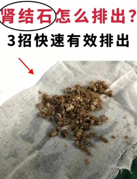 排肾结石最好的方法_如何快速排出肾结石-第2张图片-山城妙识